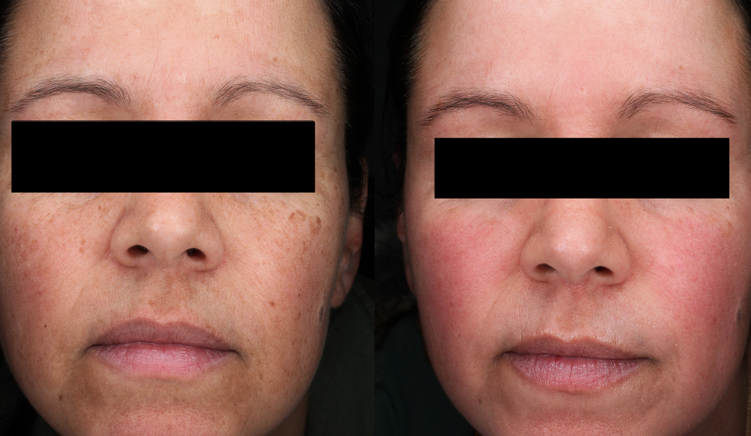 Cosmelan Treatment in Lucknow – Dr. Asma Skin Specialist